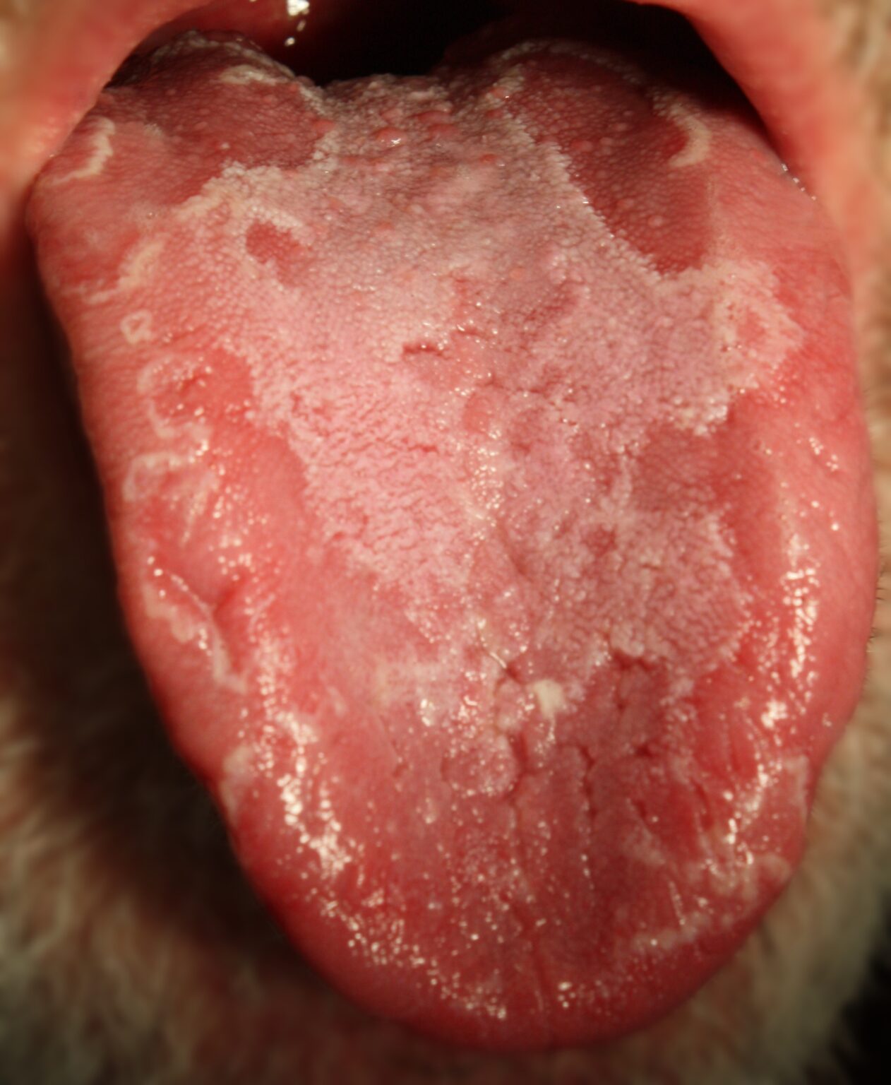 white tongue, candida, oral thrush, leukoplakia, lichen planus